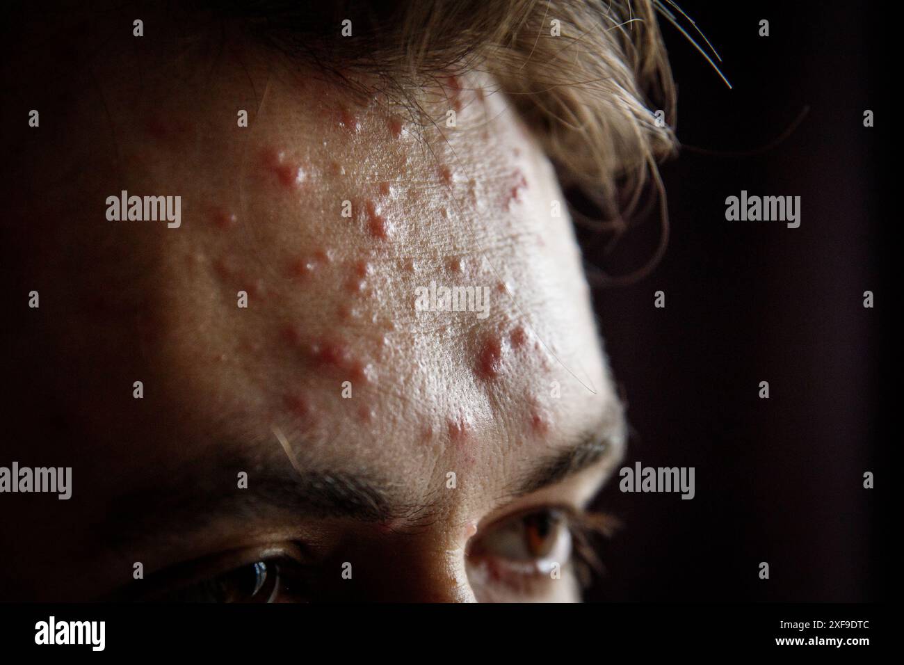 Chickenpox virus rash on the forehead of an adult Stock Photo - Alamy