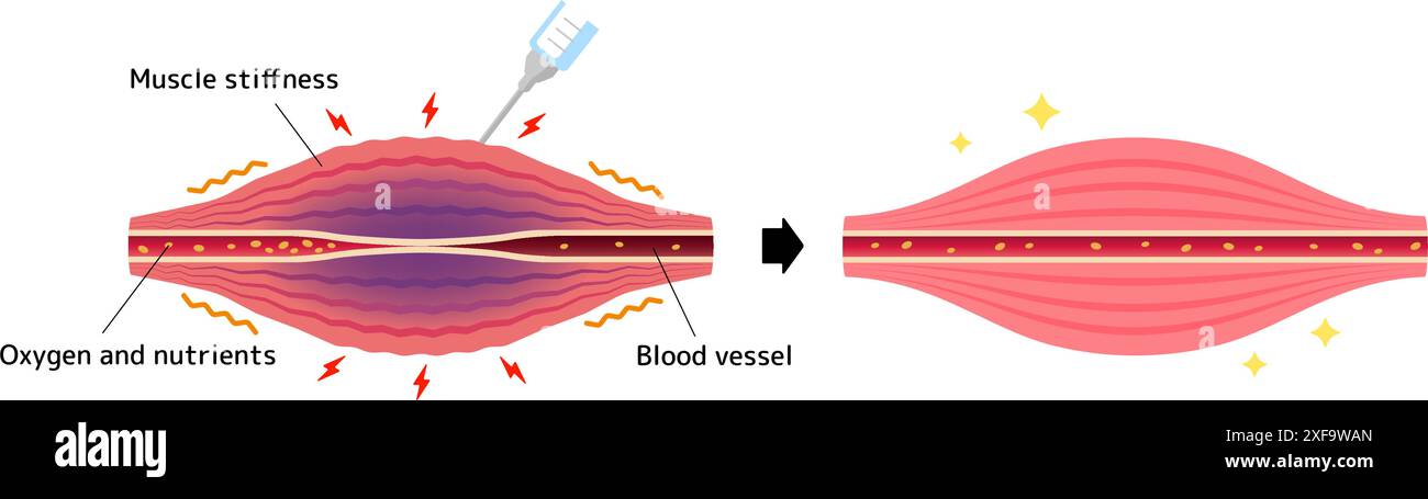 Mechanism of muscle relaxation by botulinum toxin injection Stock ...