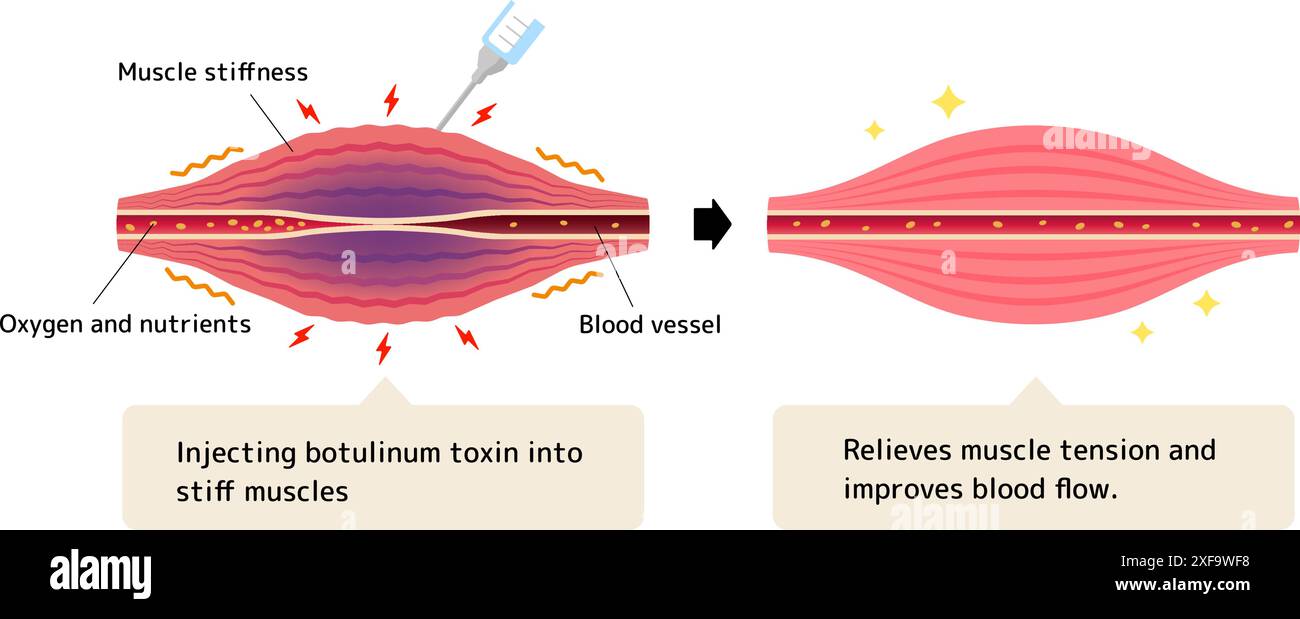 Mechanism of muscle relaxation by botulinum toxin injection Stock ...