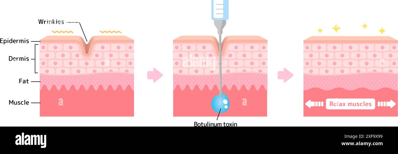 Mechanism of wrinkle improvement with botulinum toxin injection Stock ...