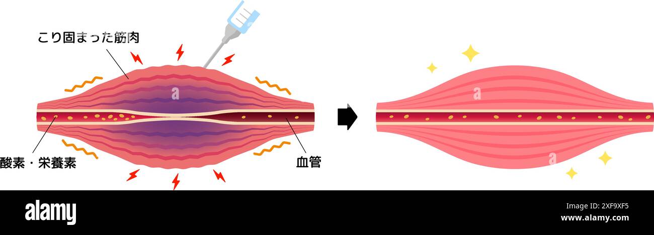Mechanism of muscle relaxation by botulinum toxin injection Stock ...