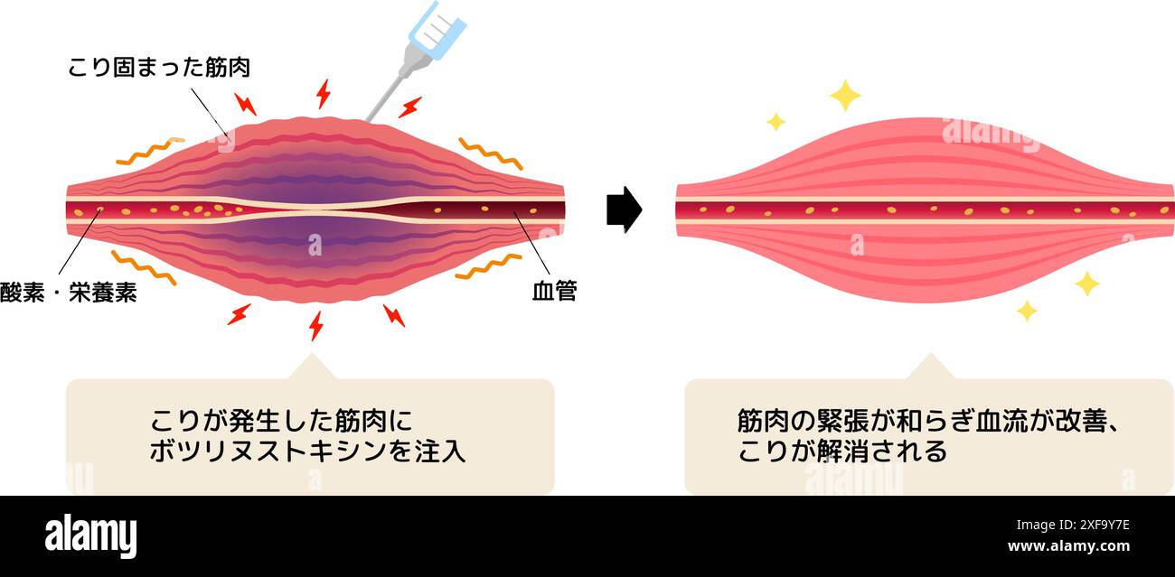 Mechanism of muscle relaxation by botulinum toxin injection Stock ...