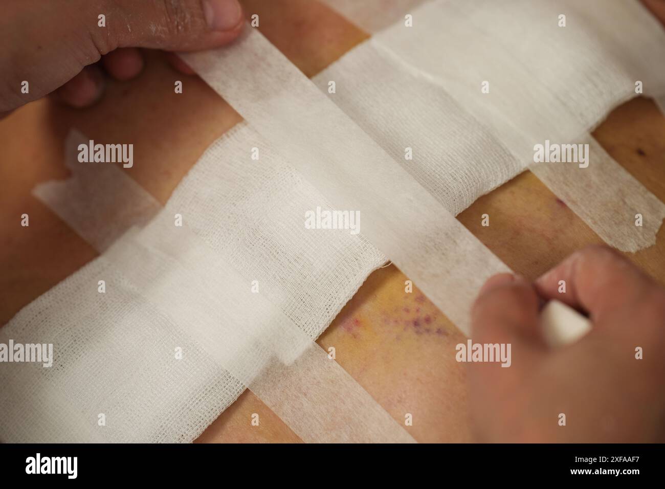 Open heart surgery scar hi-res stock photography and images - Alamy