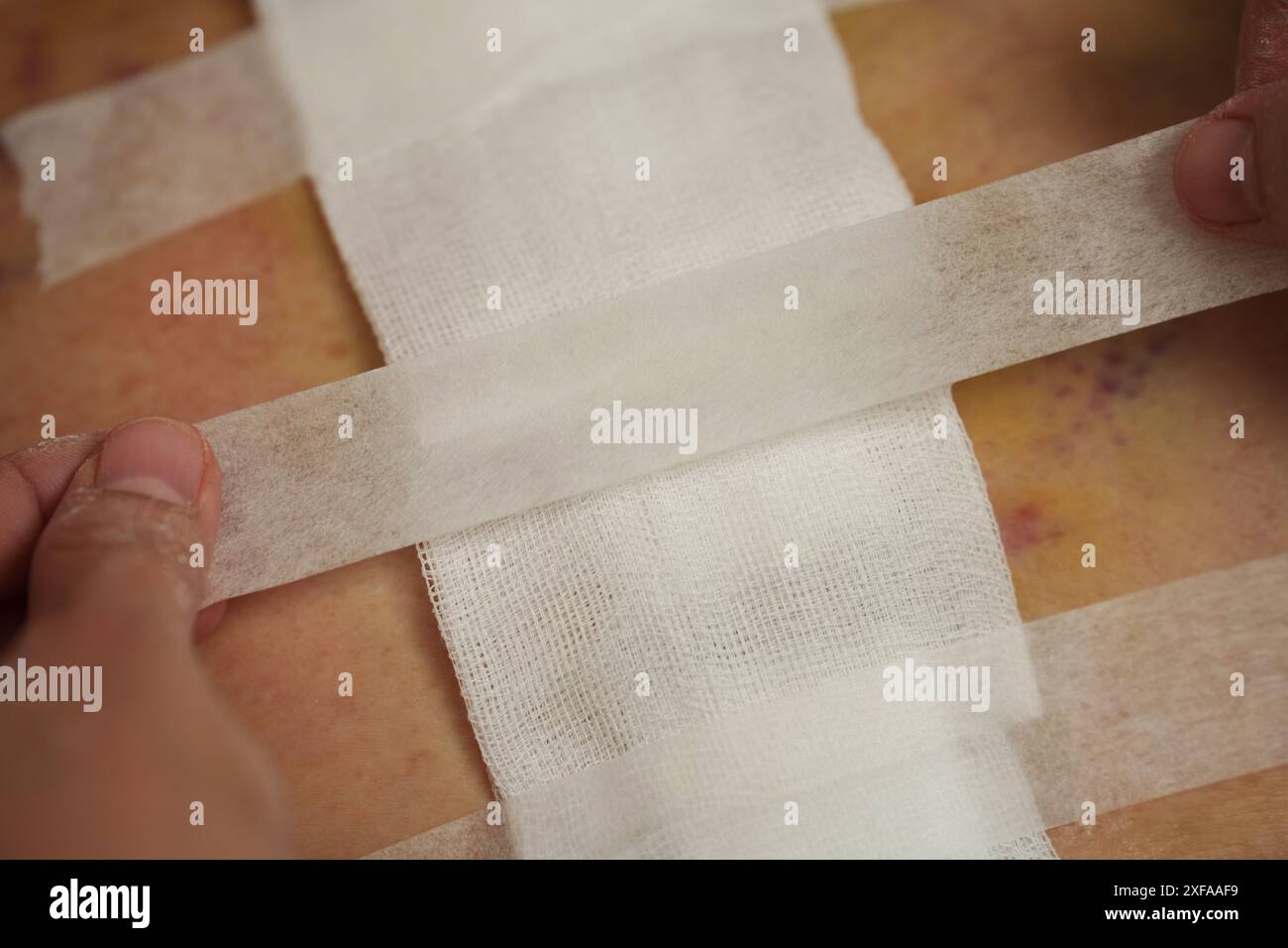 doctor is bandaging of patient after cleaning the wound from heart ...