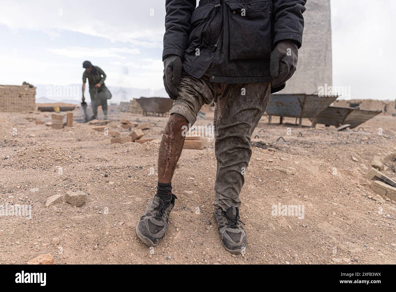 A worker who fell from the top of the brick kiln and broke his leg. Now ...
