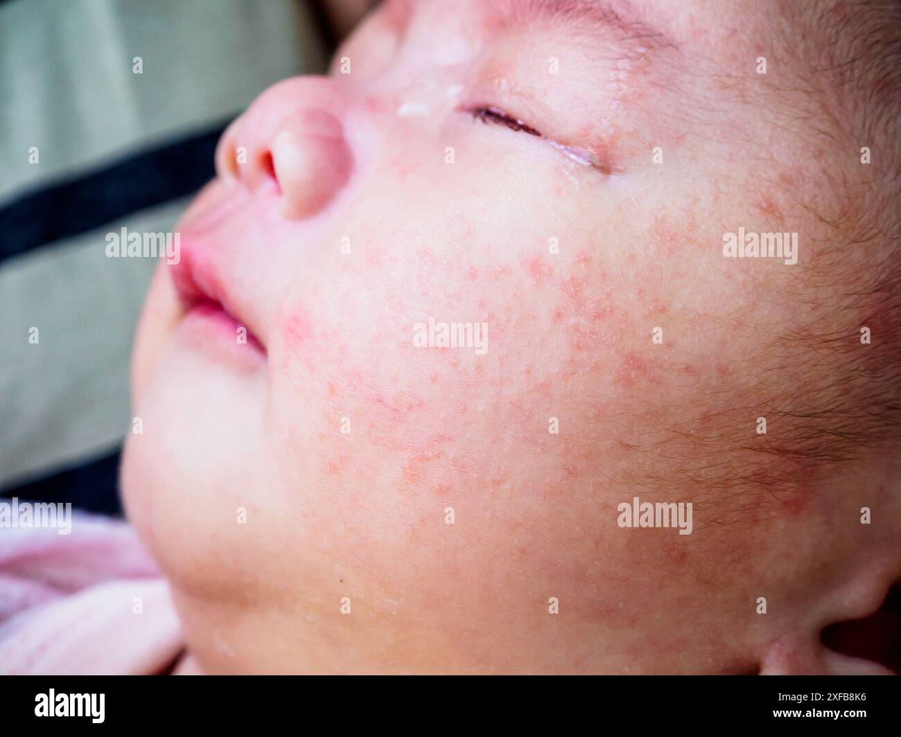 newborn baby with dermatitis allergy on face Stock Photo - Alamy