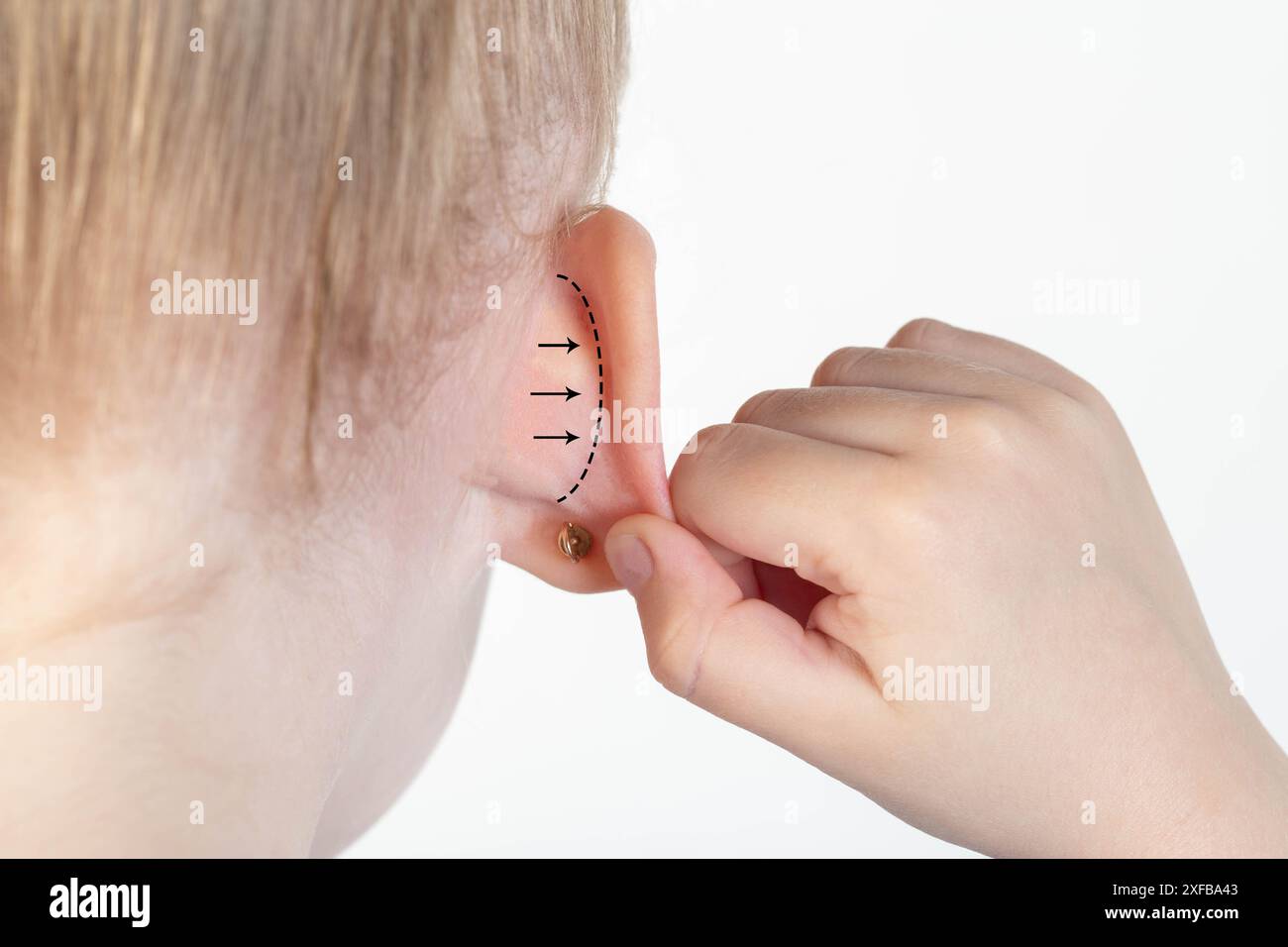 The girl holds her hand on her protruding protruding ear with marks for ...