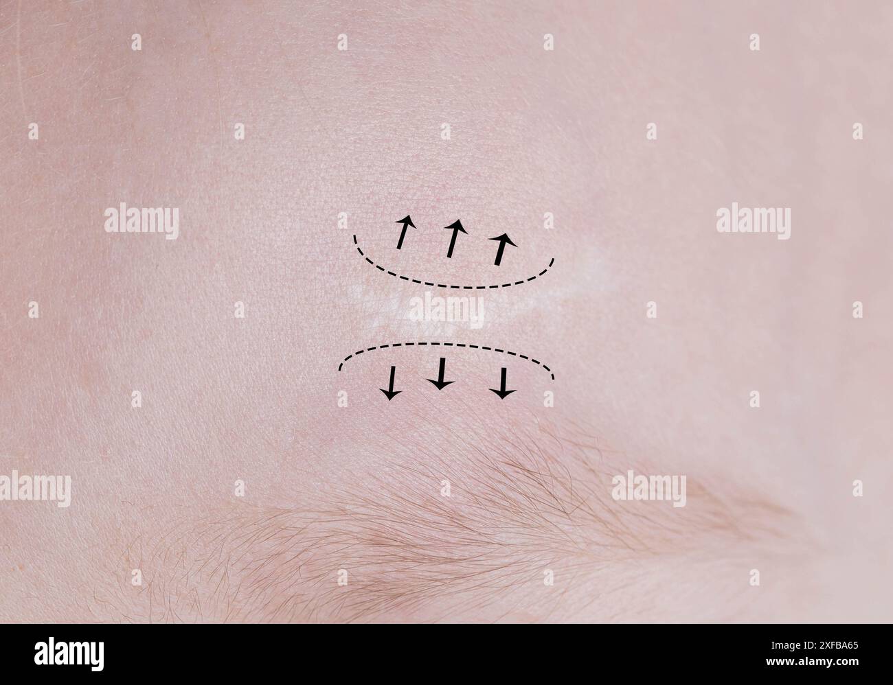 A scar on the forehead of a child with black marks before surgical ...