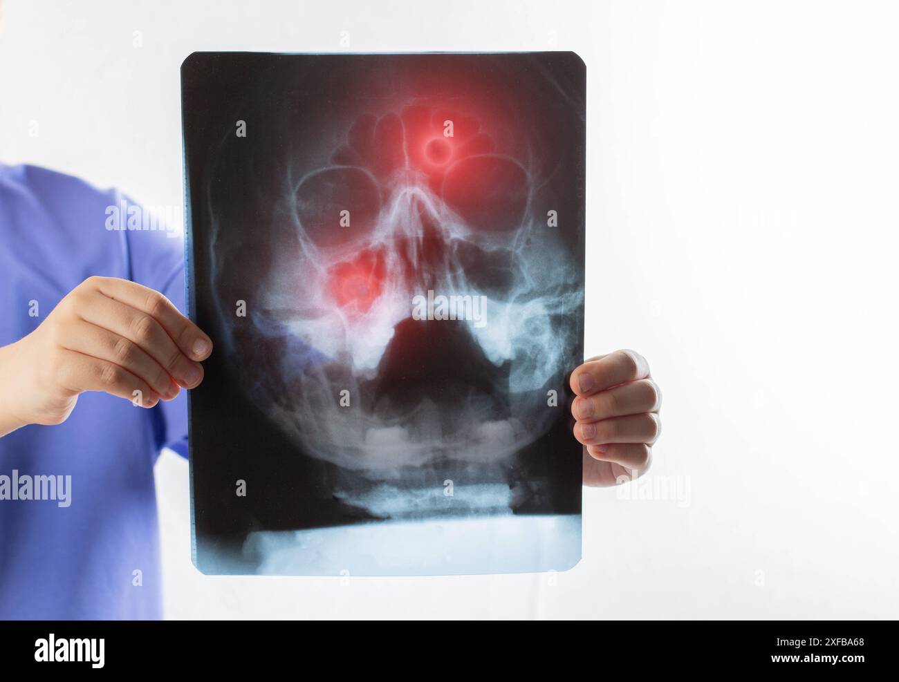 X-ray image showing red spots of inflammation of the maxillary sinuses ...
