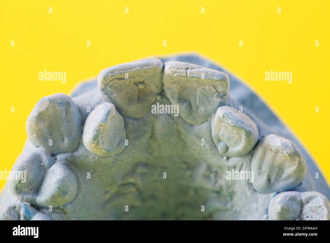 Blue plaster impression of a patient's dental jaw with crooked teeth ...