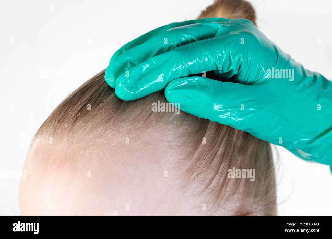 The doctor examines the girl's head and hair for bald spots and scalp ...
