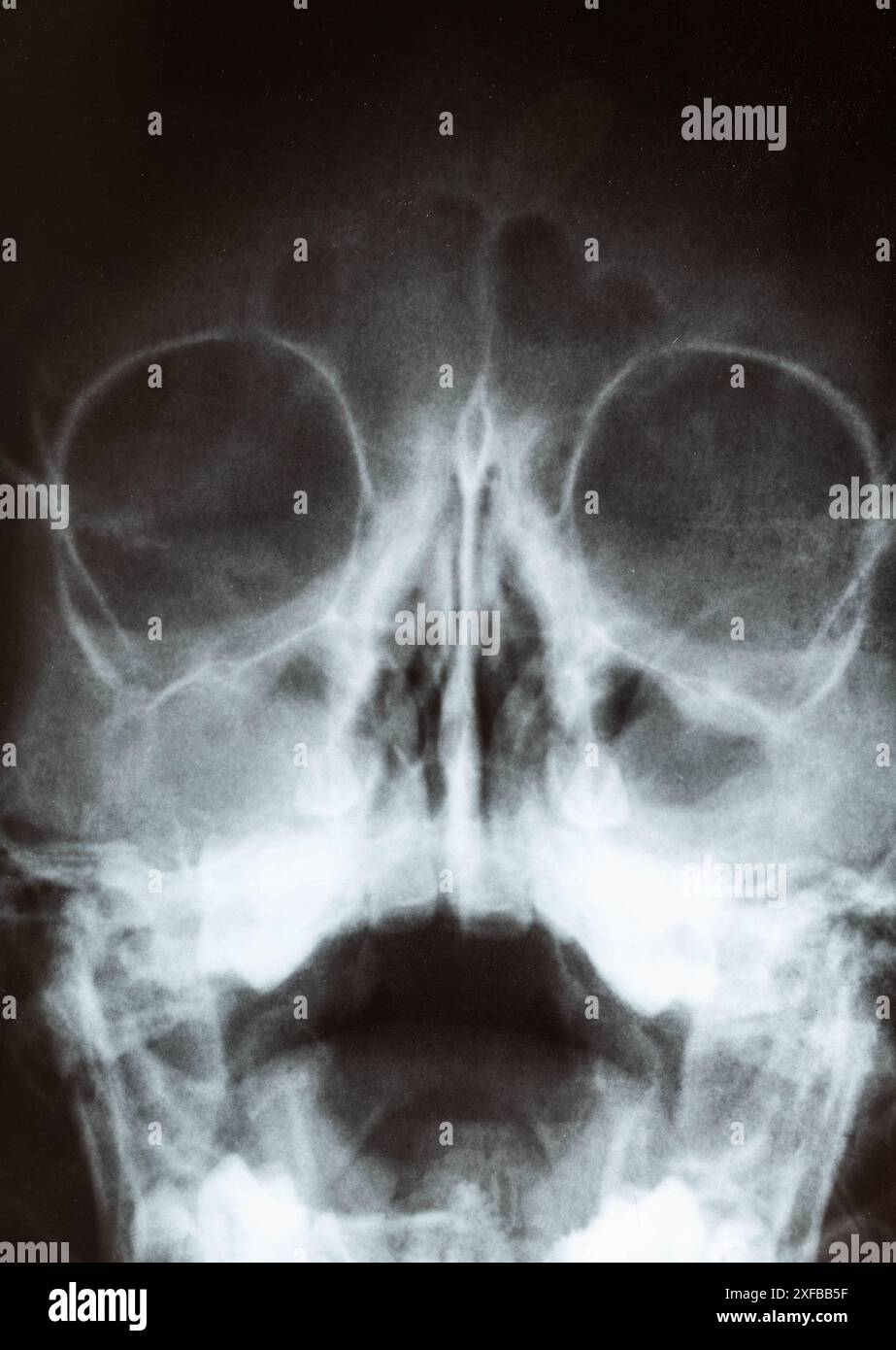 X-ray image of the skull of a child with purulent sinusitis, close-up ...