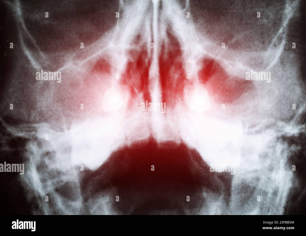 X-ray image of the skull of a child with purulent sinusitis, close-up ...