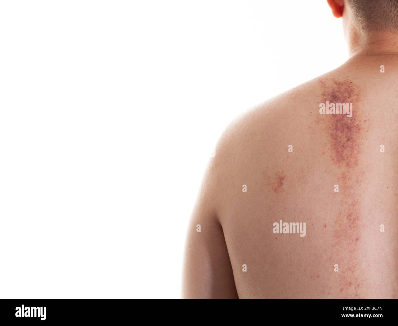 Bruises on back hi-res stock photography and images - Alamy