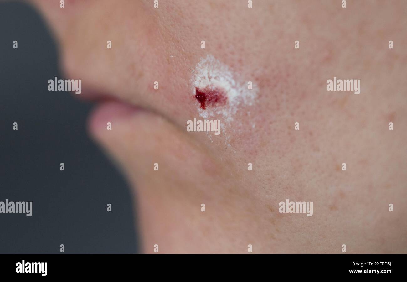 Treatment of a wound and injury on a girl s cheek. Ointments for skin ...