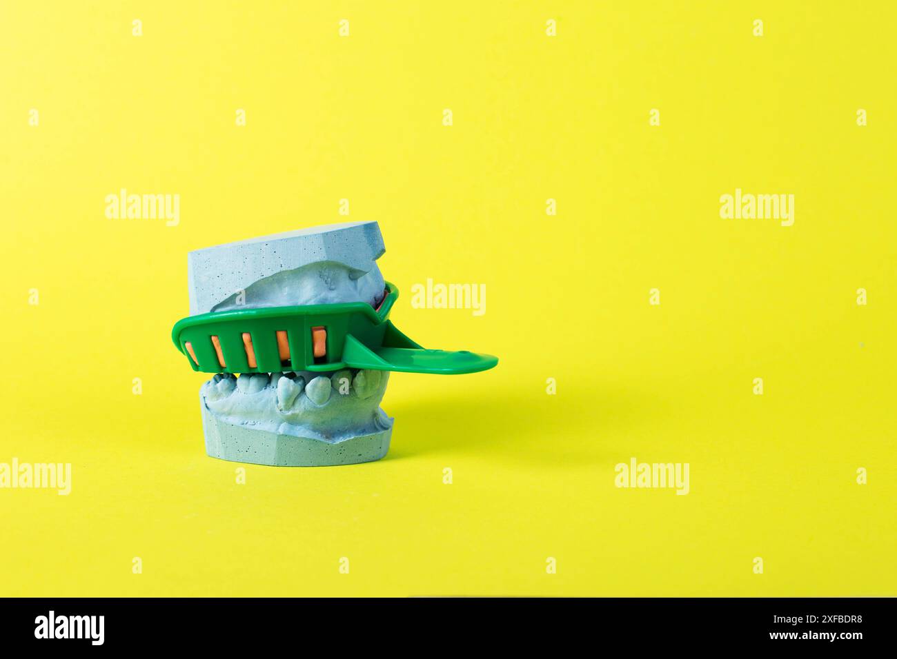 Green dental impression tray on a blue plaster jaw of a patient on a ...