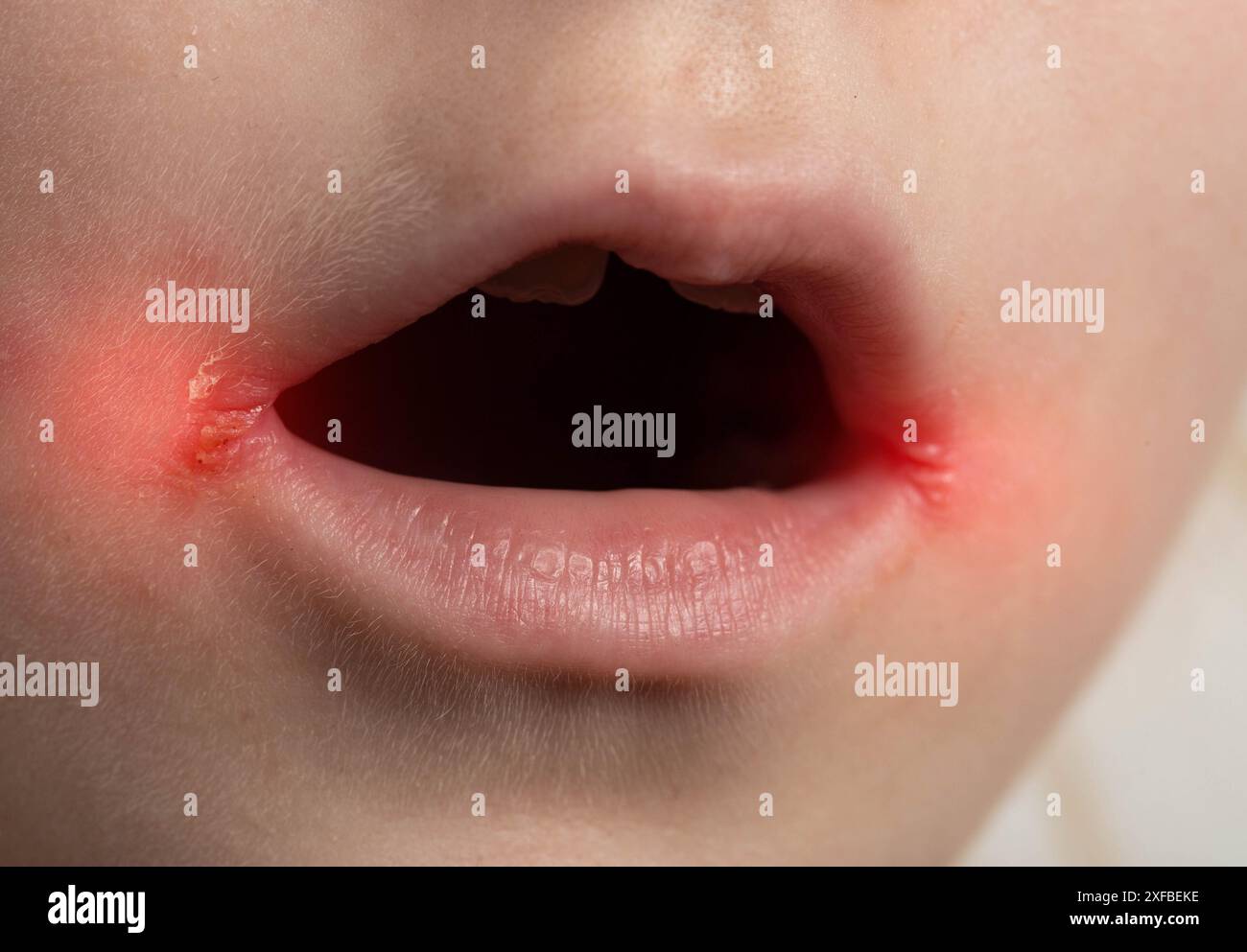 Seizures on the corners of the lips of a child s mouth. Bacterial ...