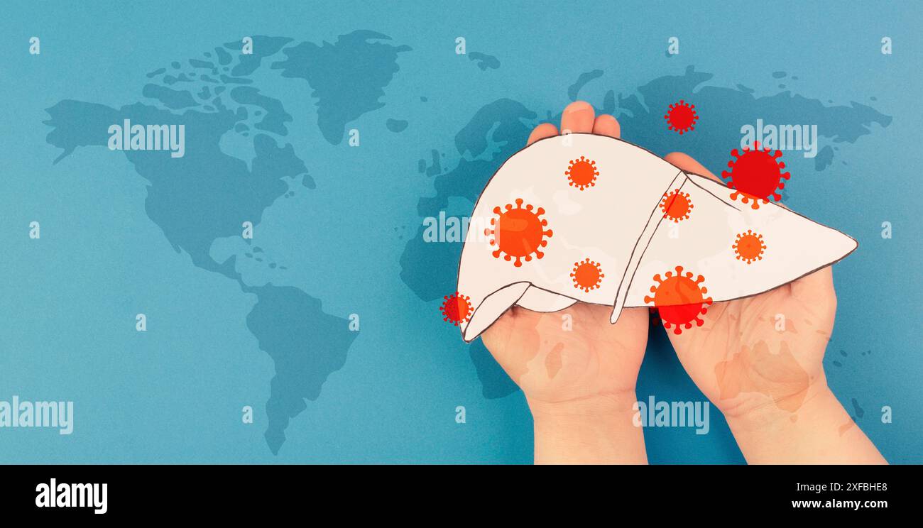 Liver organ infected with virus, world hepatitis day, diagnosis of ...