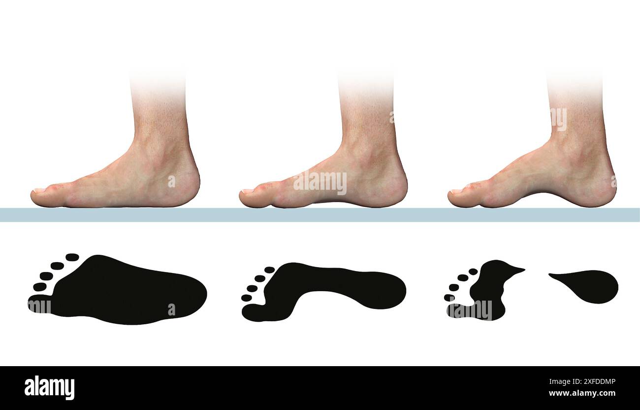 Illustration showing the footprints left by a flat foot (left), a ...