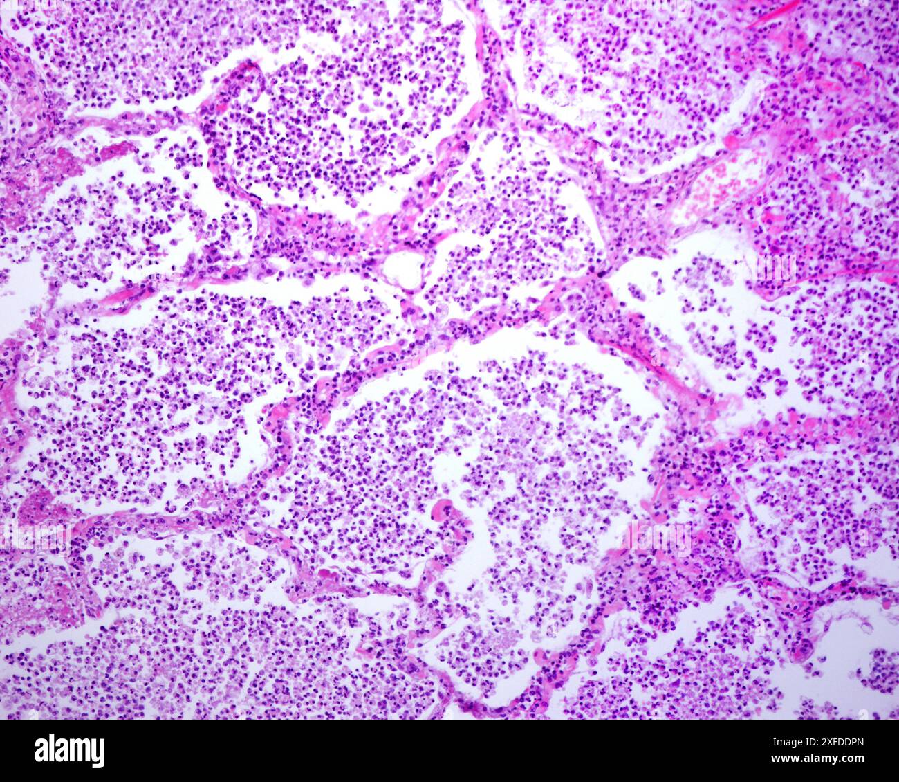 Light micrograph showing a human lung affected by acute pneumonia. The ...