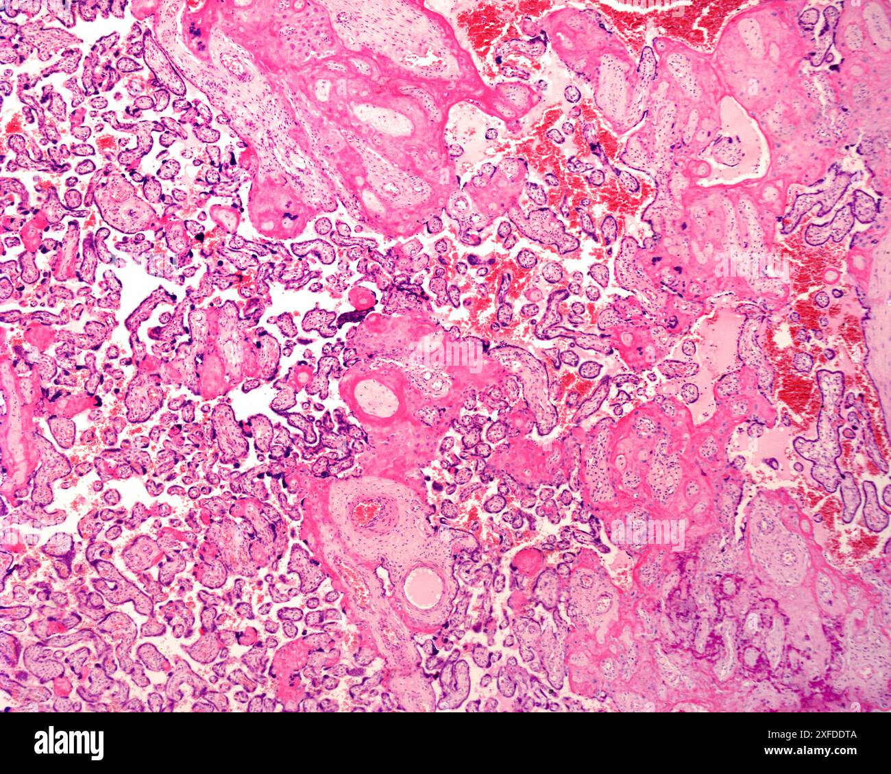 Light micrograph of a human term placenta showing several large ...
