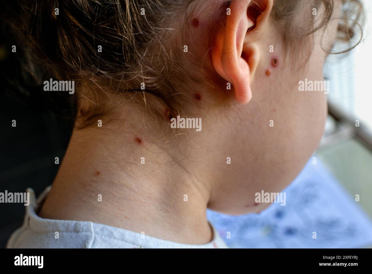 Child with chickenpox spots, childhood illness caused by the varicella ...