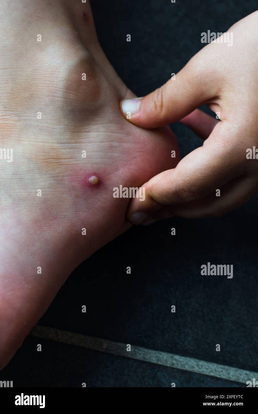 Child with chickenpox spots, childhood illness caused by the varicella ...