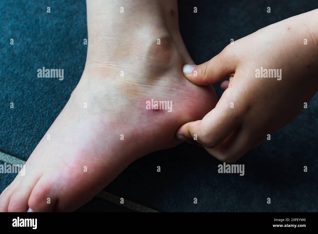 Child with chickenpox spots, childhood illness caused by the varicella ...