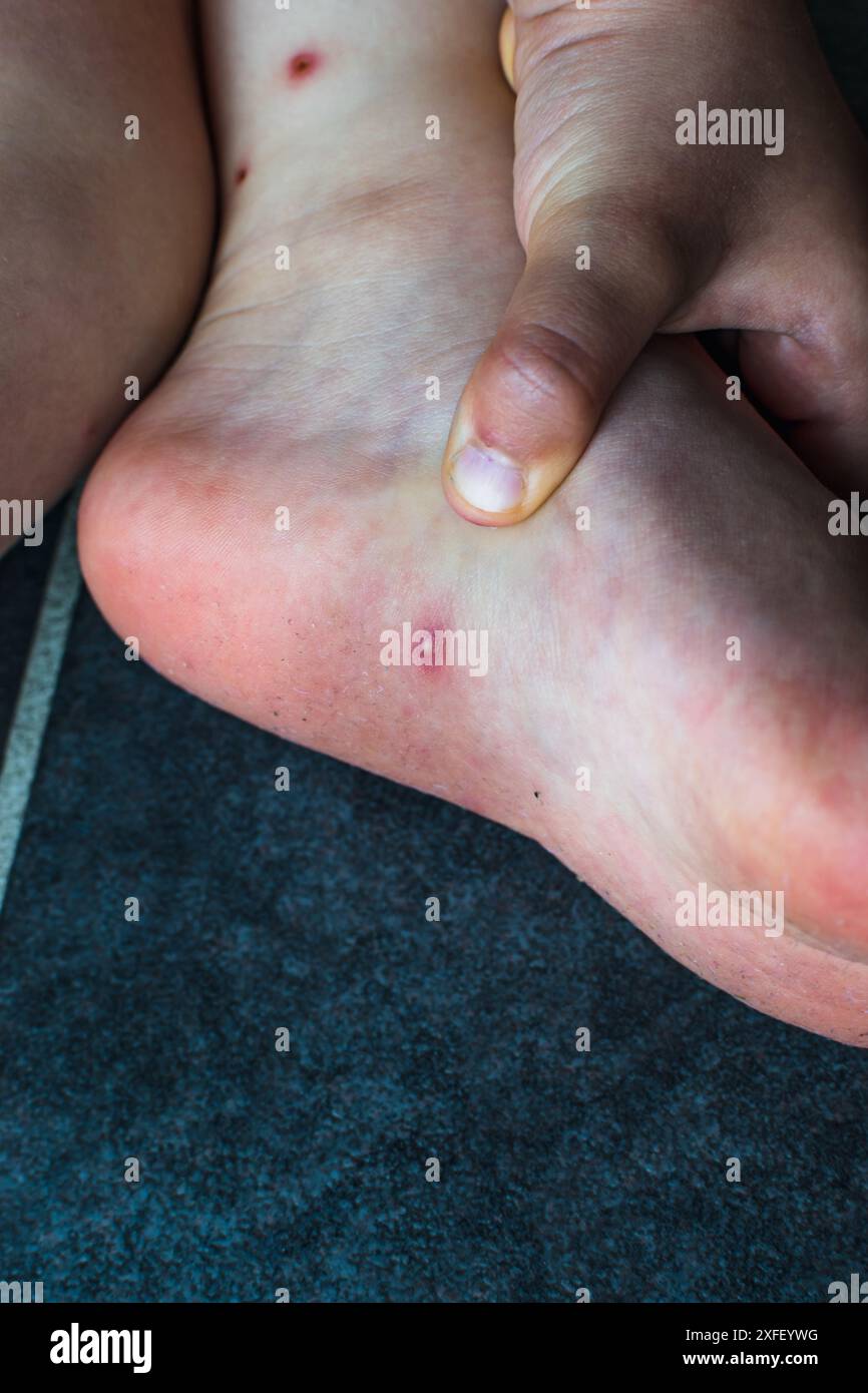 Child with chickenpox spots, childhood illness caused by the varicella ...