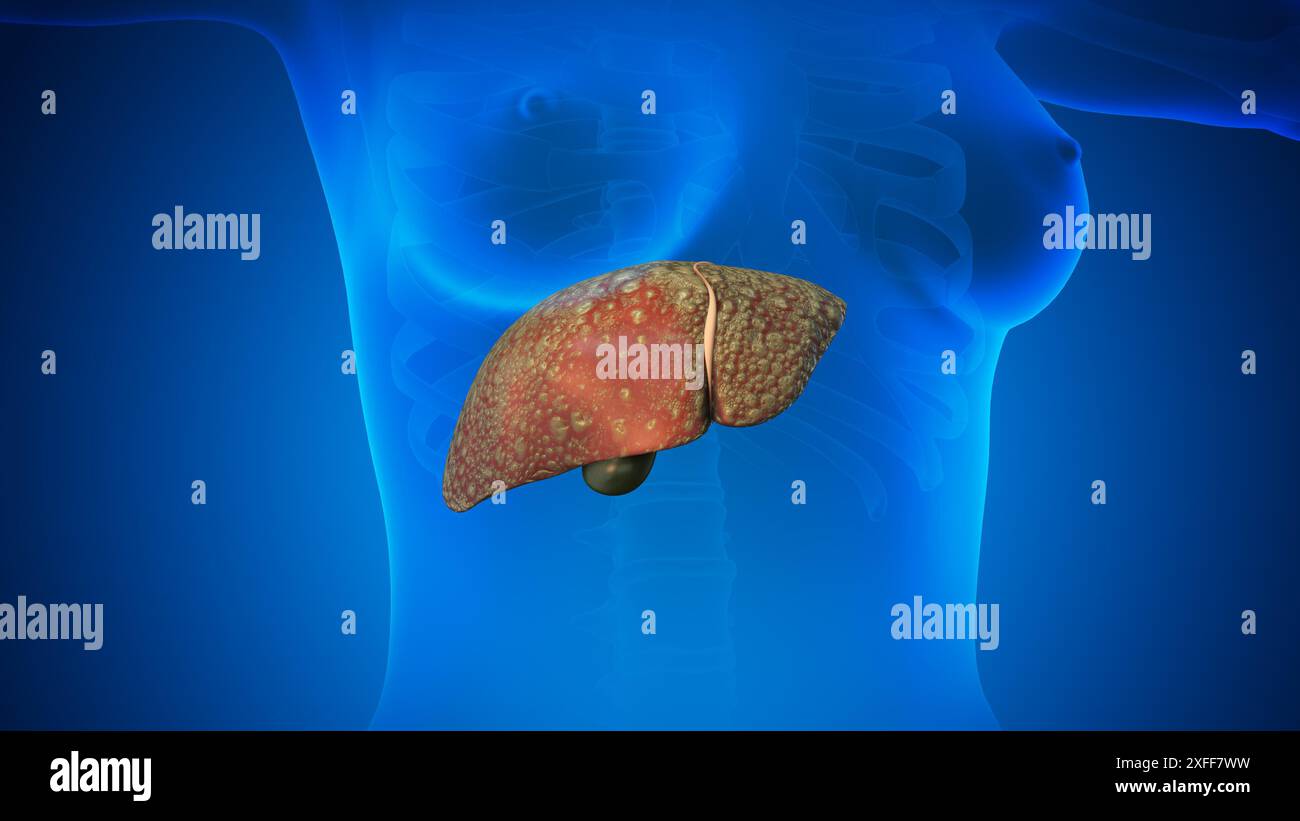 Female healthy liver turning into a fatty liver Stock Photo - Alamy