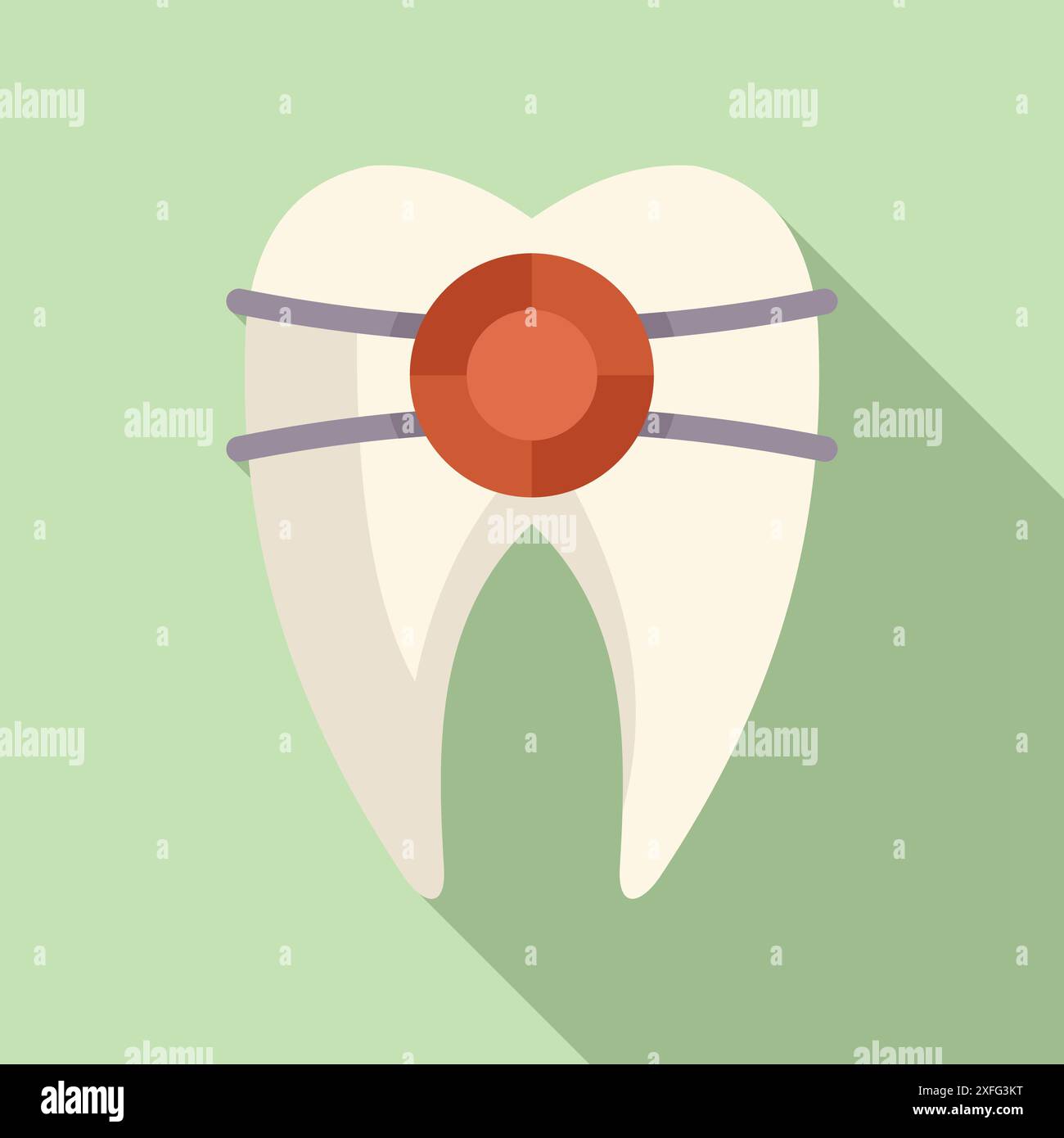 Tooth with braces is undergoing orthodontic treatment to straighten and ...