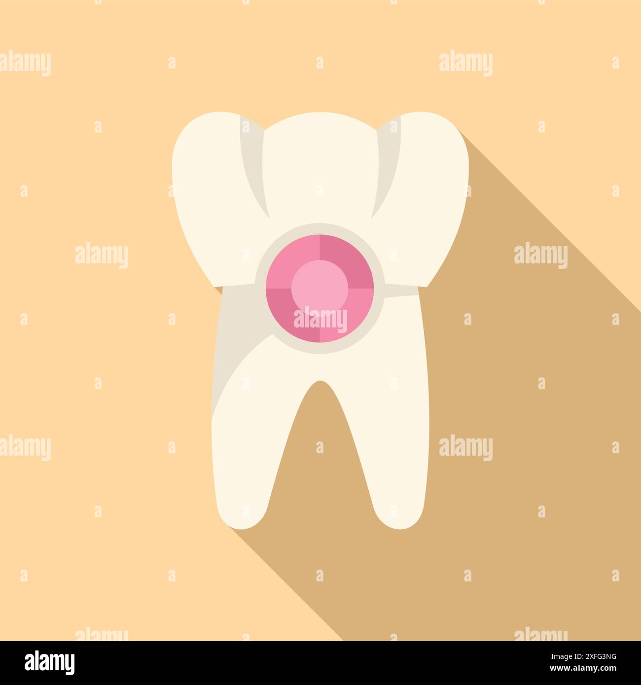 Tooth showing filling being capped during appointment with a dentist ... Tooth showing filling being capped during appointment with a dentist ...