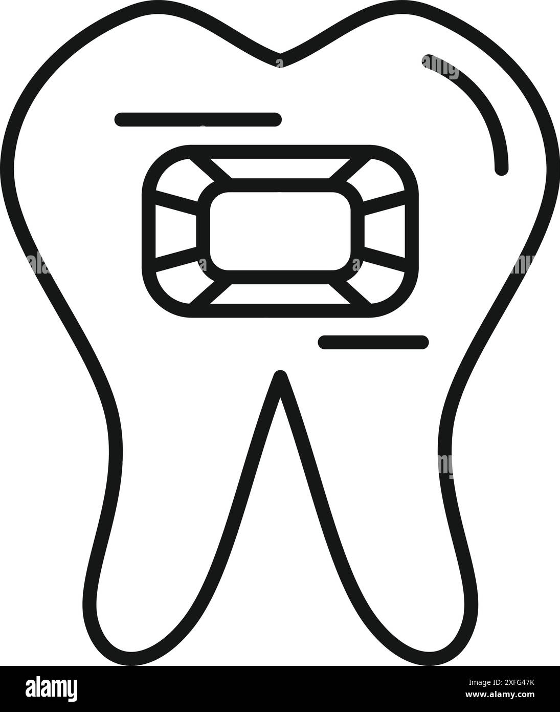 Tooth implant surgery showing diamond inlay for dental care Stock ...