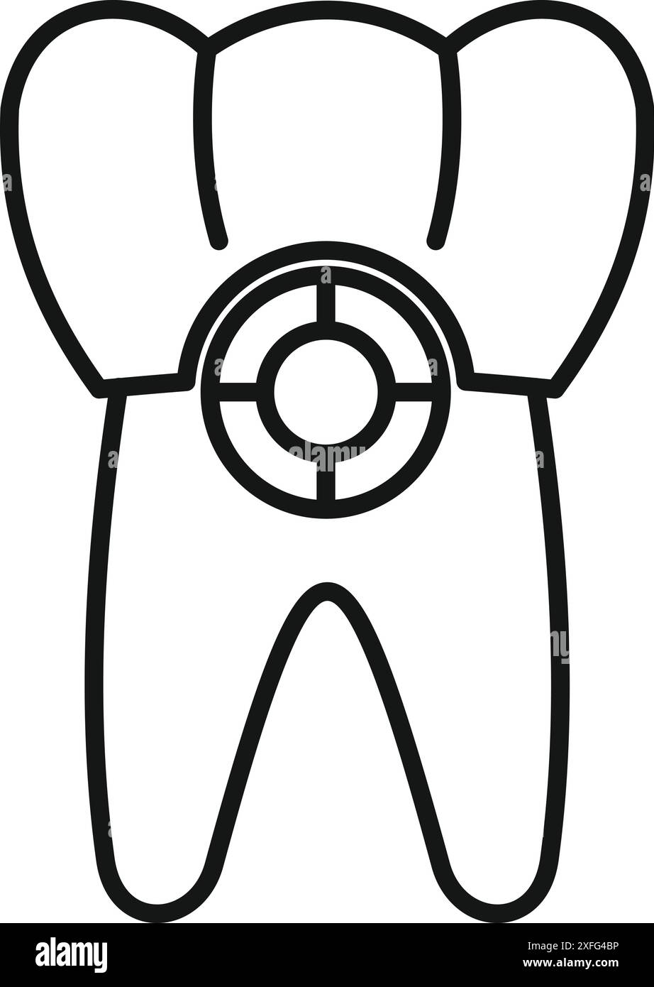 Line drawing of a tooth receiving a dental implant Stock Vector Image ...