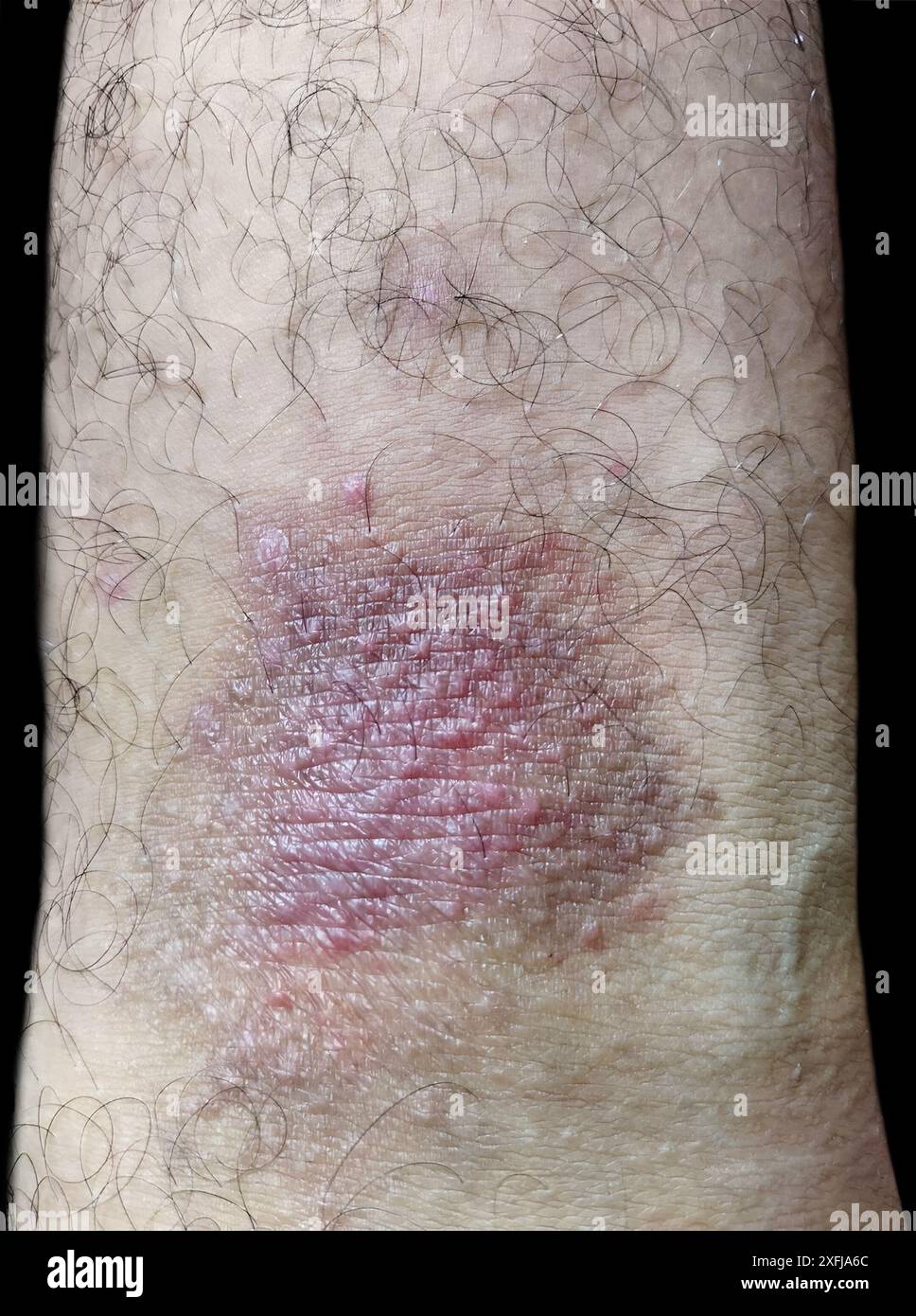 Hyperkeratosis hi-res stock photography and images - Alamy