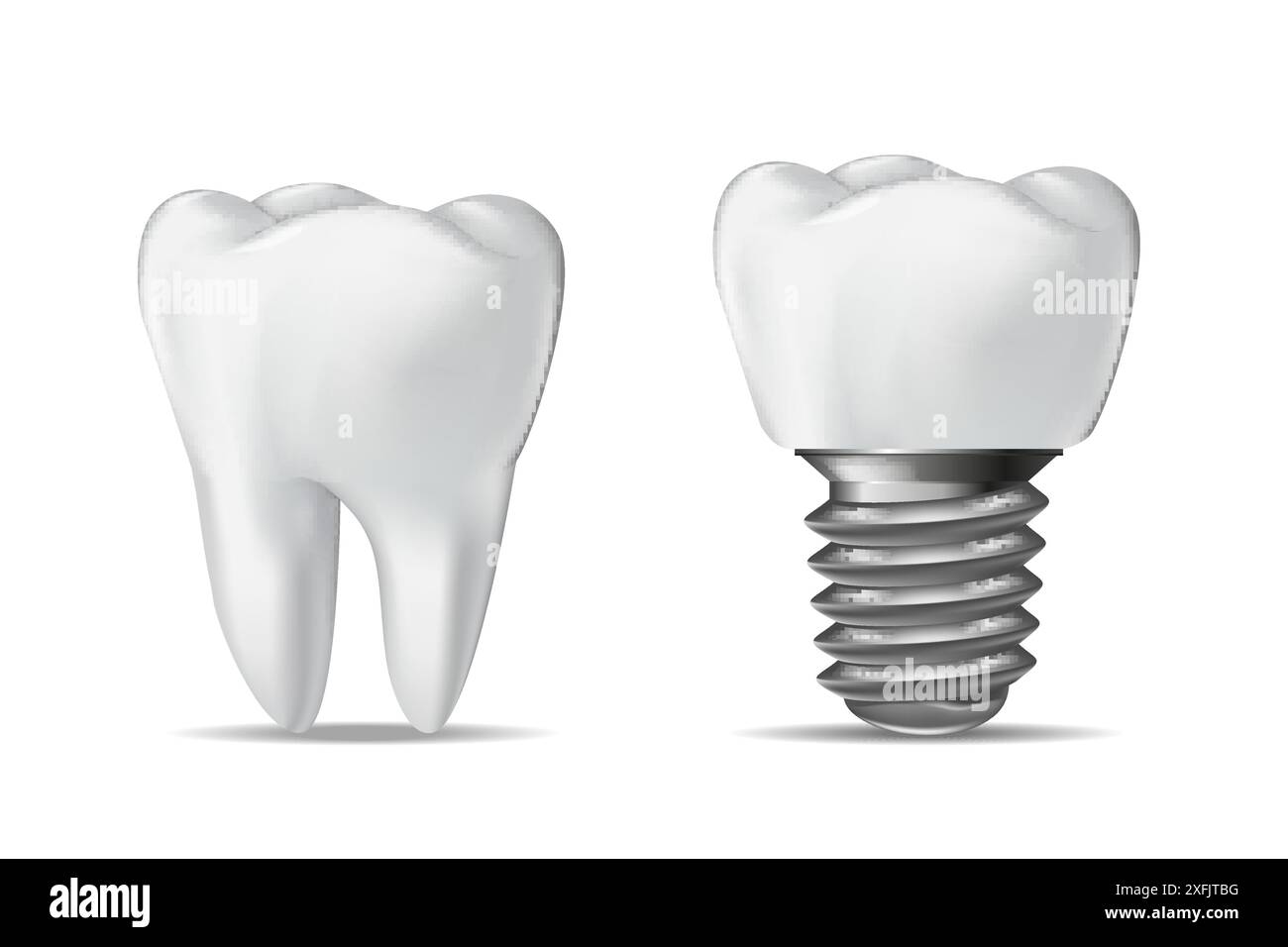 Human Tooth and Dental Implant, dental concept, realistic vector ...