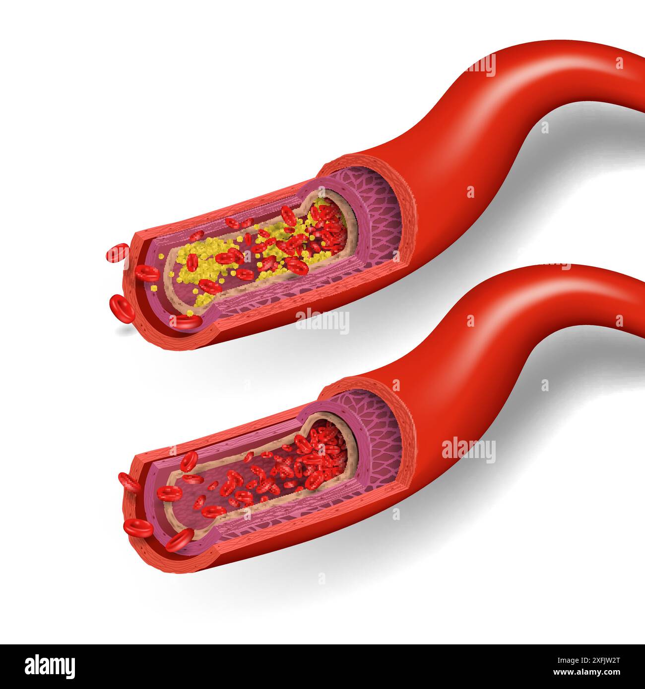 Healthy and Cholesterol Blocked Blood Vessels, medical concept on white ...