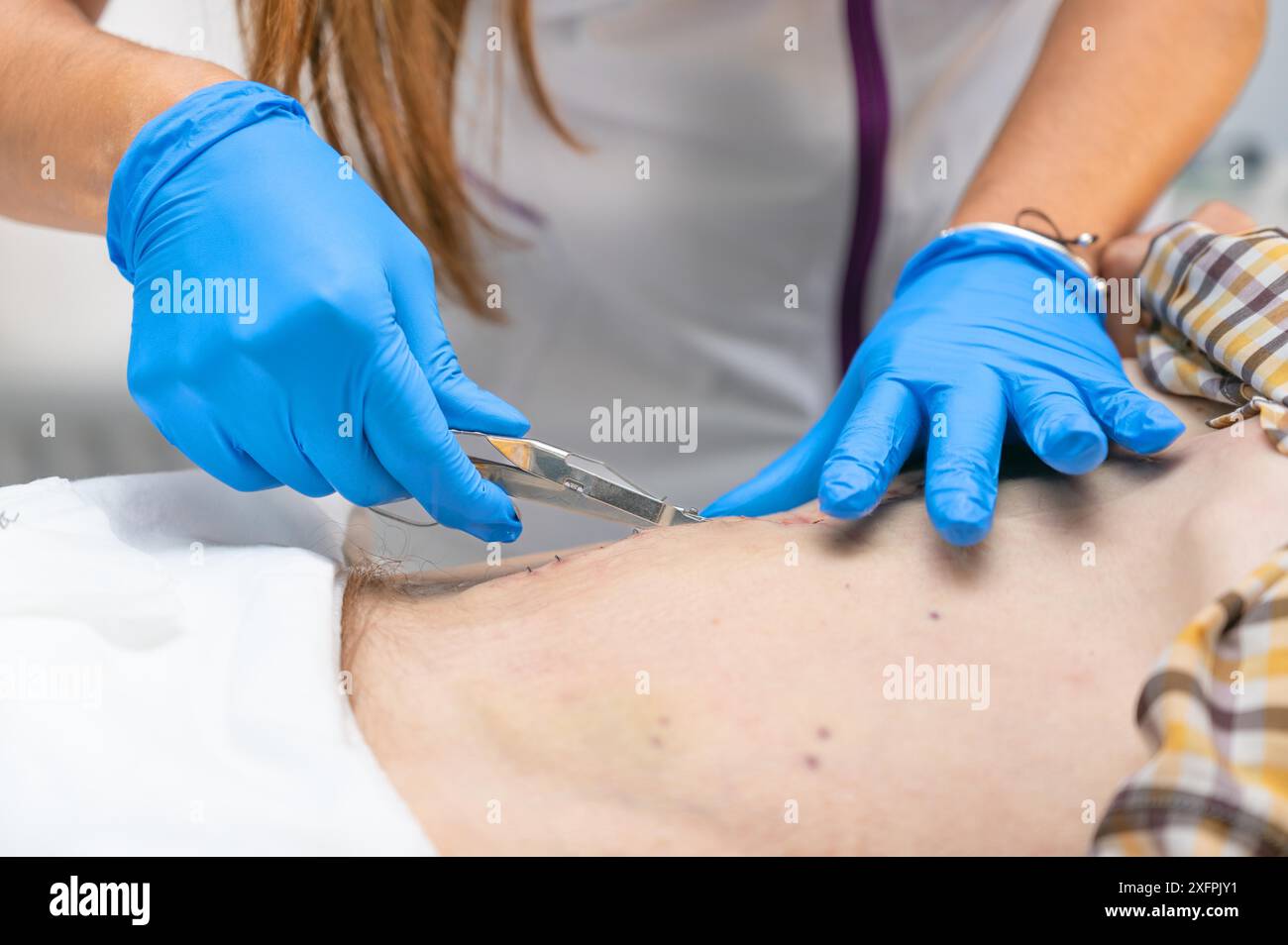 Nurse removing surgical stitches from the abdomen of a patient ...