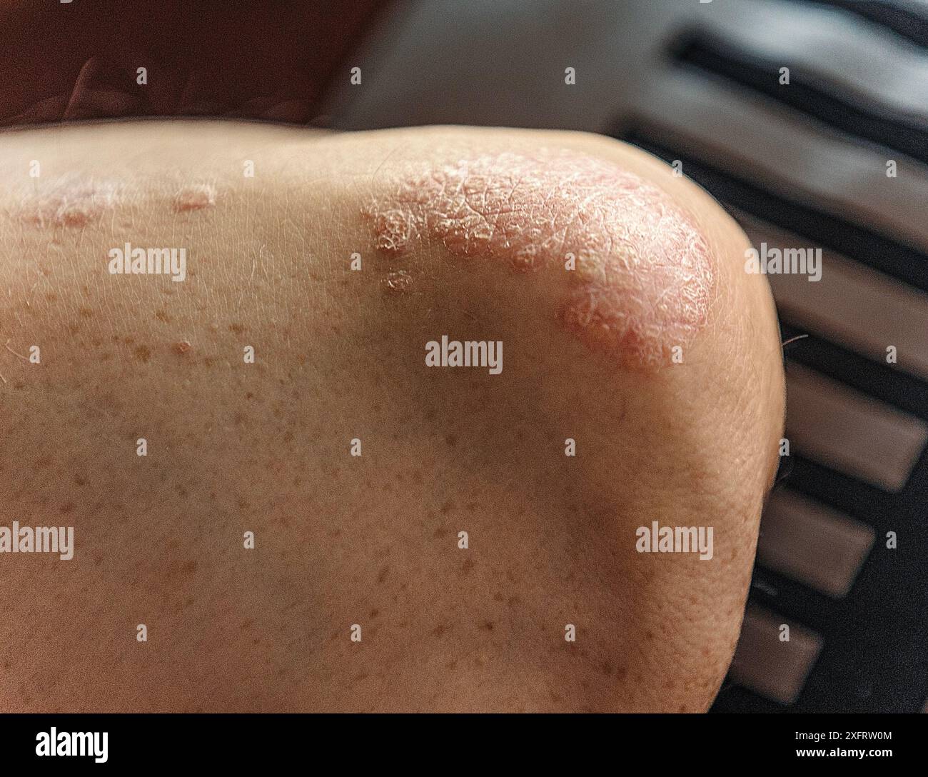 Elbow psoriasis hi-res stock photography and images - Alamy