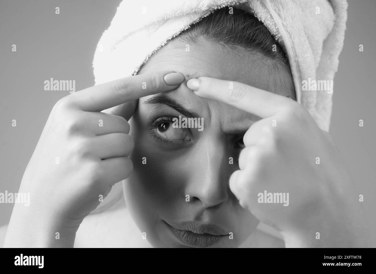 Close up Woman squeeze out pimples on forehead. Acne and pimple on skin ...
