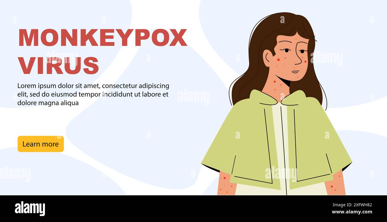Monkeypox outbreak concept banner. Infected girl from monkey flat ...