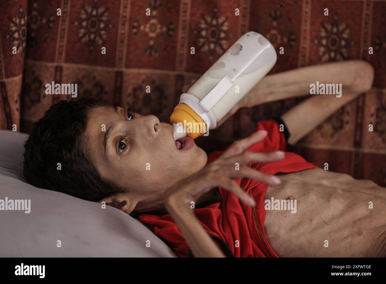 A Palestinian boy, Ahmed Al-Najjar, 21 years old, suffers from ...