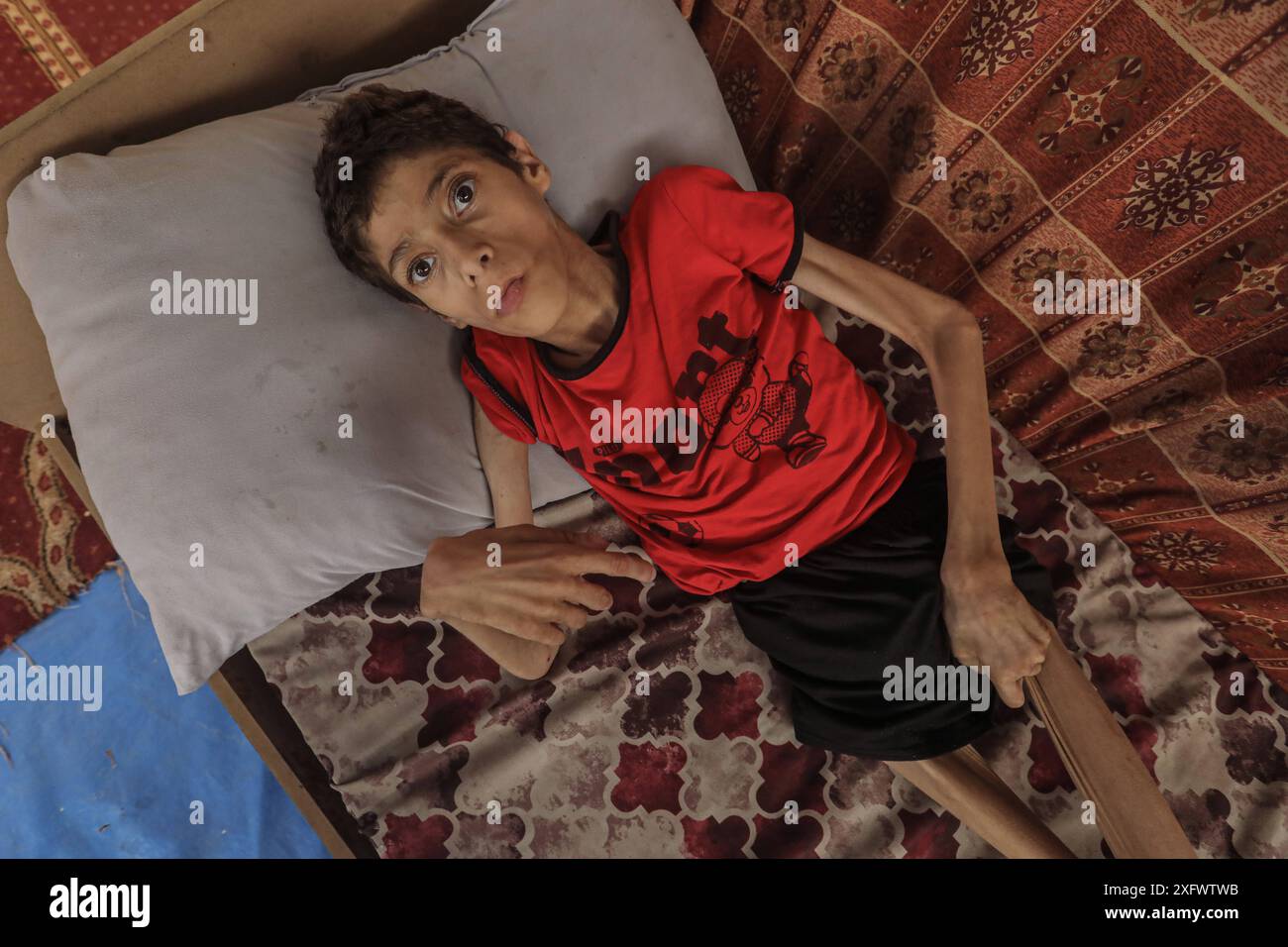 A Palestinian boy, Ahmed Al-Najjar, 21 years old, suffers from ...