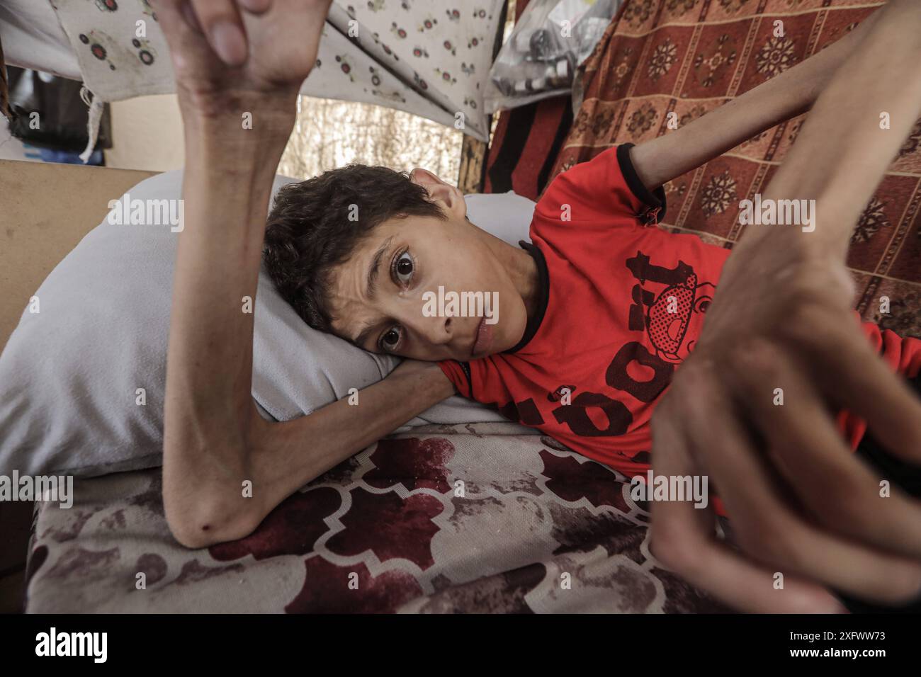 A Palestinian boy, Ahmed Al-Najjar, 21 years old, suffers from ...