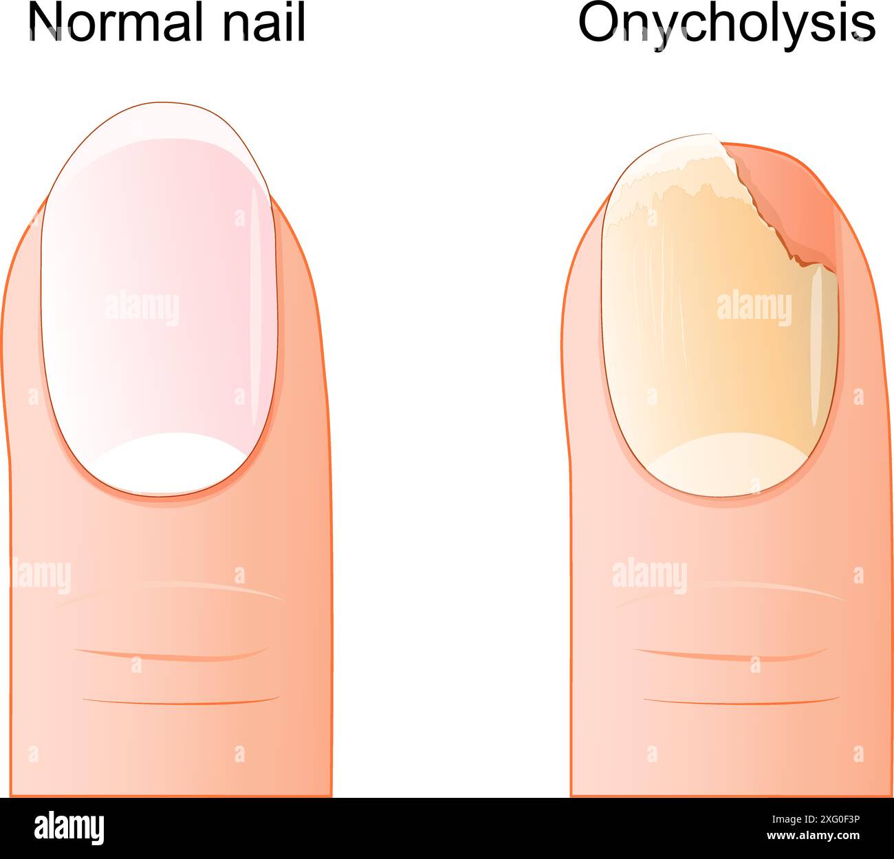 Structure of the nail plate vector vectors hi-res stock photography and ...