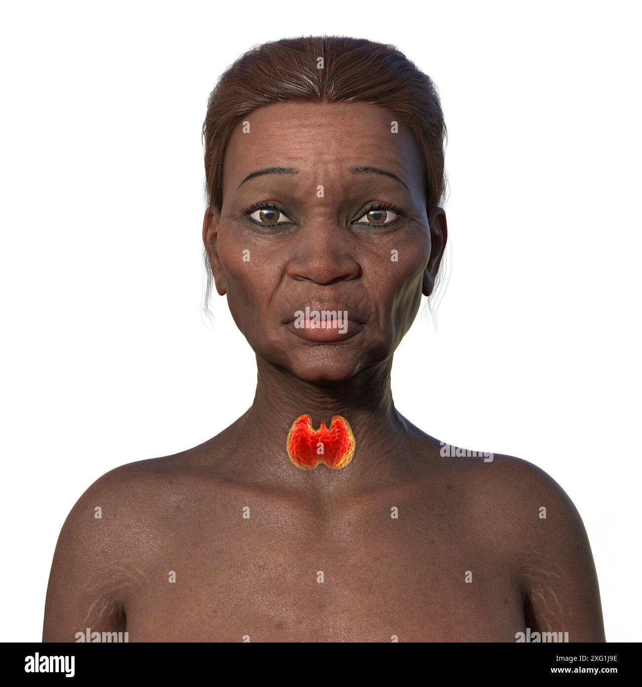 Female highlighted thyroid gland hi-res stock photography and images ...