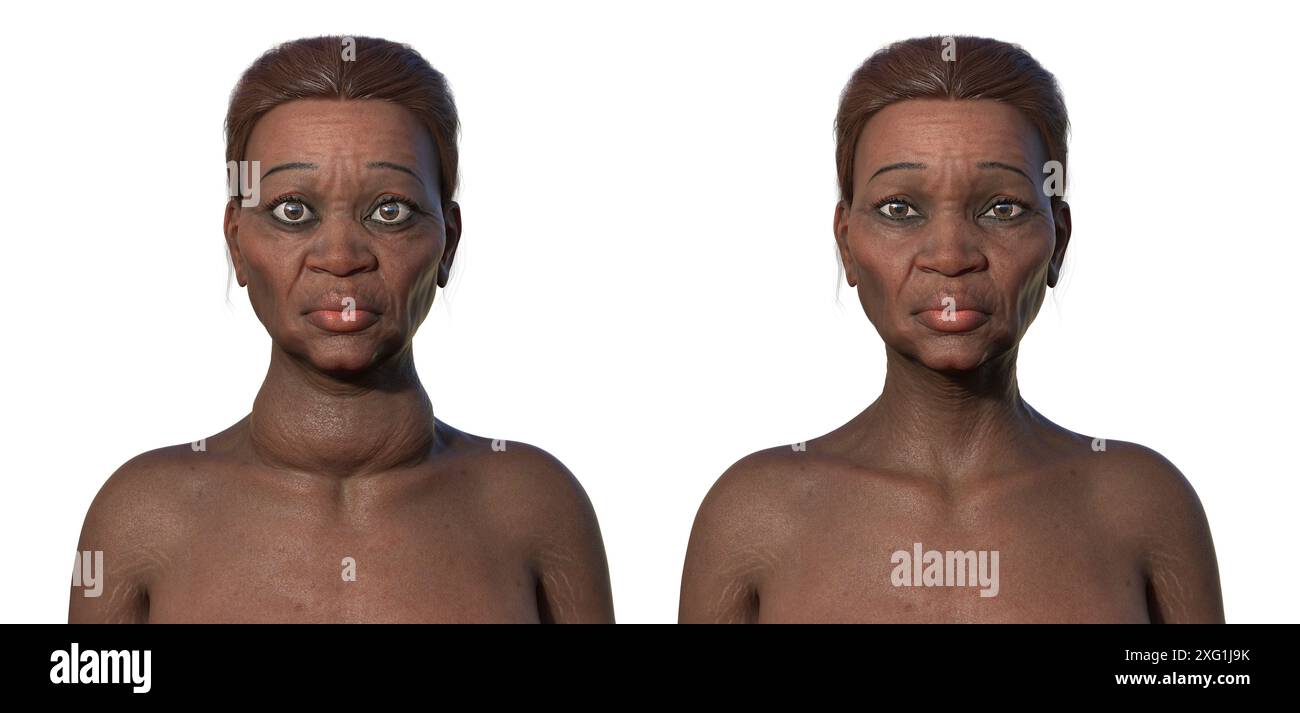 Illustration of an elderly woman with Graves' disease (left) causing an ...