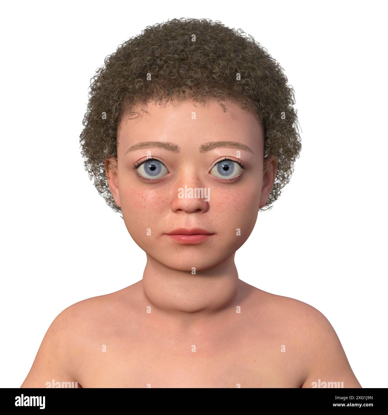 Illustration of a child with Graves' disease, causing an enlarged ...