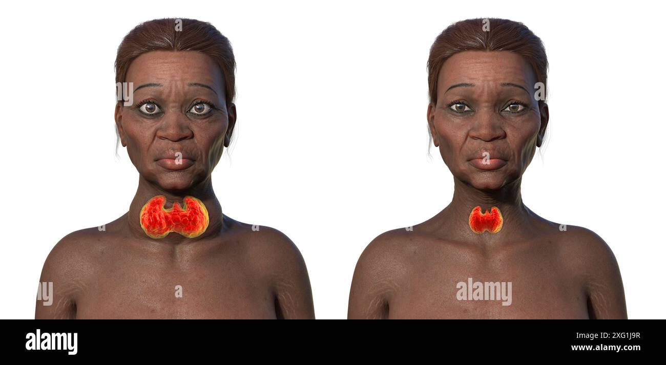 Illustration of an elderly woman with Graves' disease (left) causing an ...