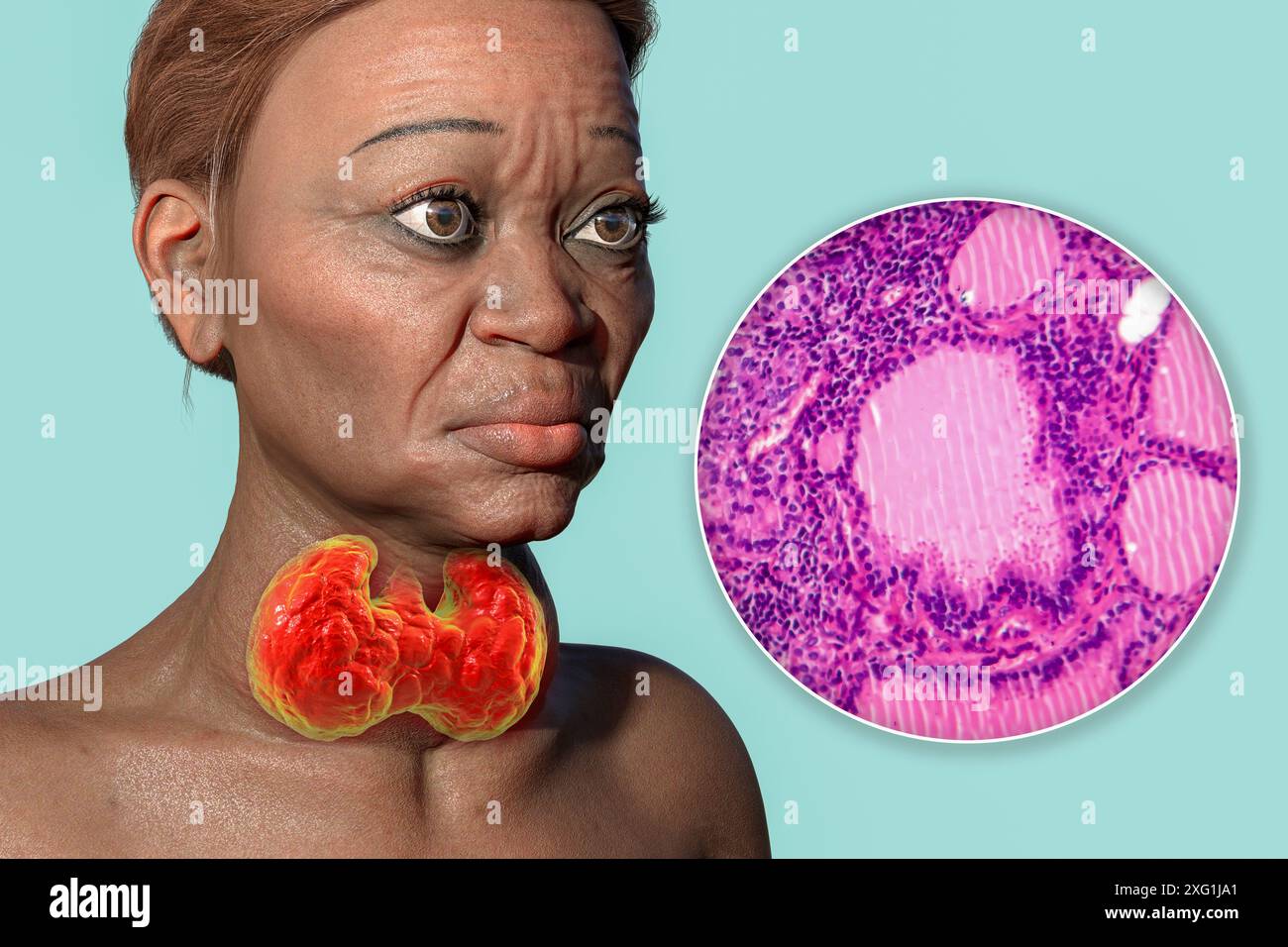 Illustration of a woman with Graves' disease and a close-up of the ...